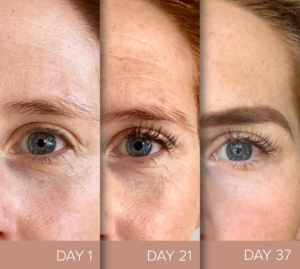 Collagen Before and After Pictures - Do you see the Difference?