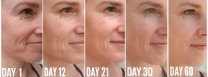 Collagen Before and After Pictures - Do you see the Difference?