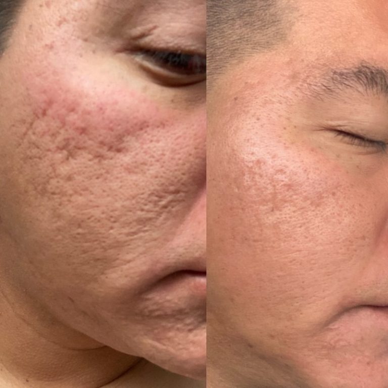 Collagen Before and After Pictures - Do you see the Difference?